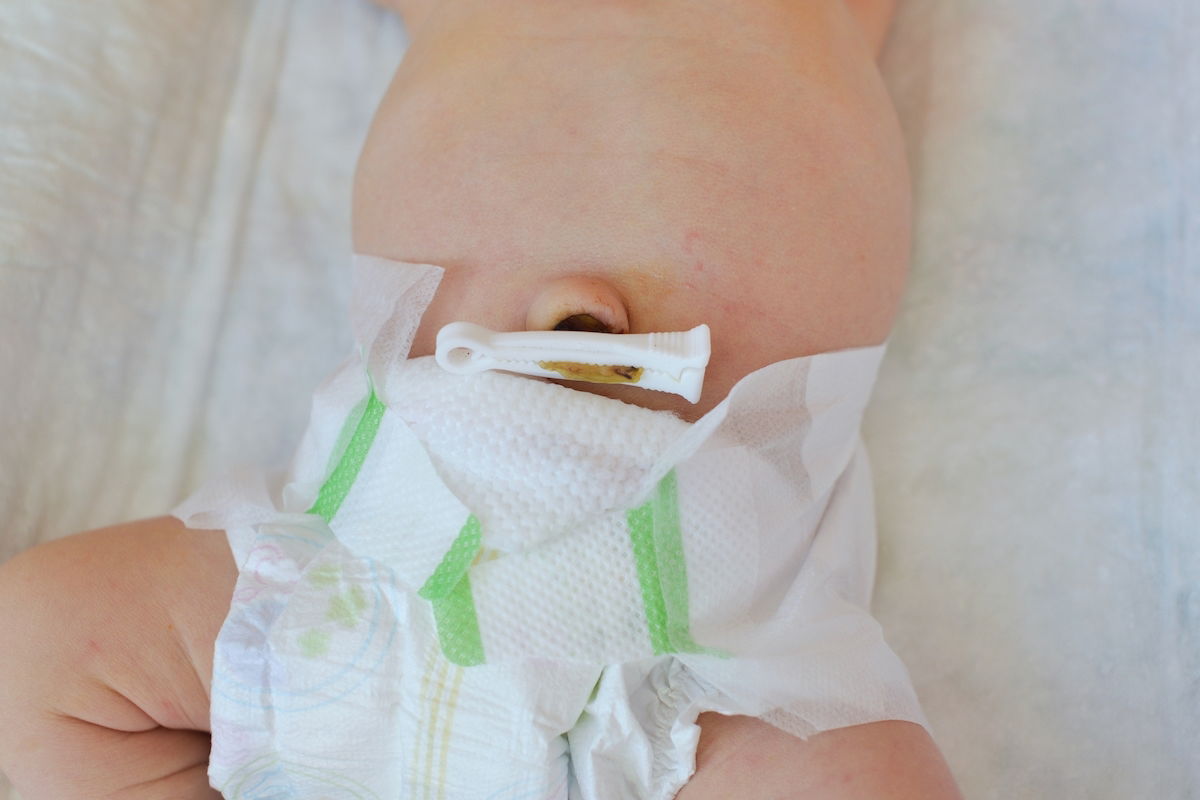 Cuidados del cordón umbilical: qué hacer antes y después de caer - Tua ... Cuidados del cordón umbilical: qué hacer antes y después de caer - Tua ...