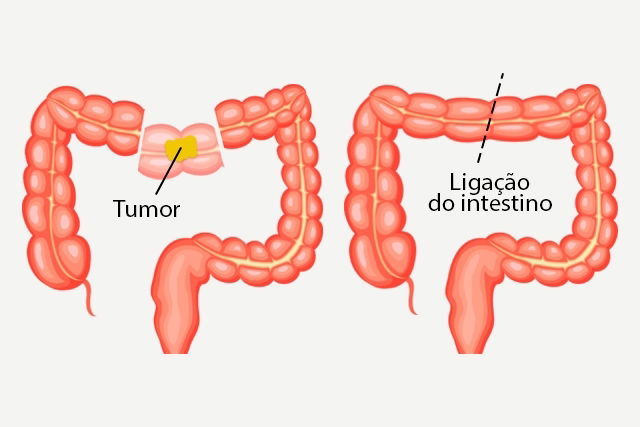 Cirurgia Para Câncer De Intestino Tipos E Recuperação Tua Saúde
