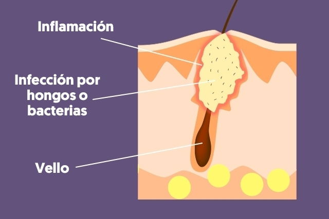 Foliculitis Qué Es Causas Y Tratamiento [fotos] Tua Saúde